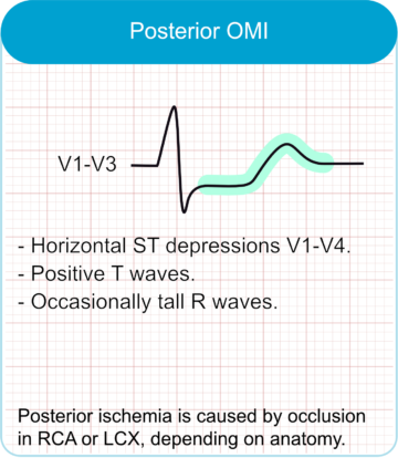 A New Approach to Acute Coronary Syndromes: Occlusion MI (OMI) vs. non ...