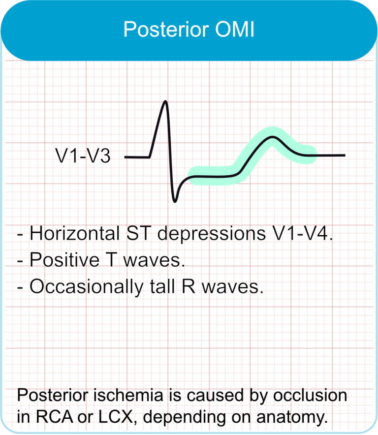 A New Approach to Acute Coronary Syndromes: Occlusion MI (OMI) vs. non ...