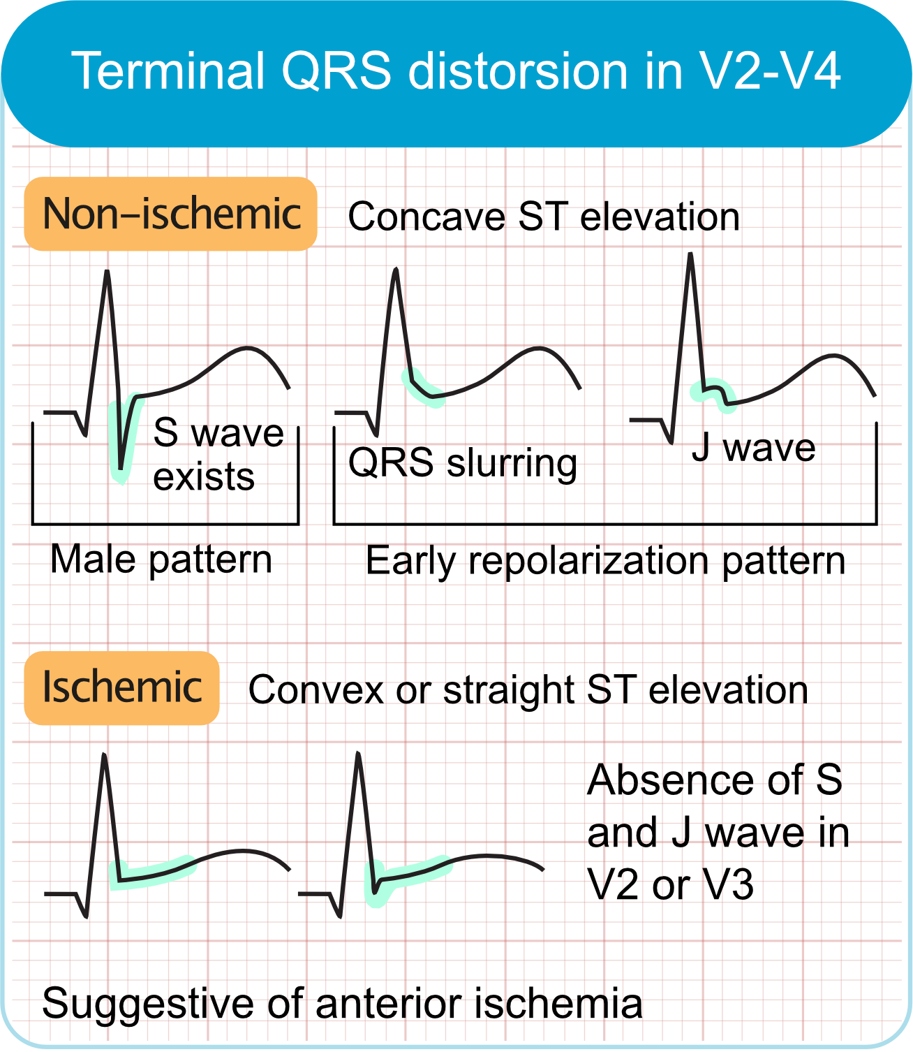 A New Approach to Acute Coronary Syndromes: Occlusion MI (OMI) vs. non ...