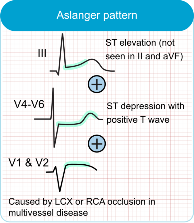 A New Approach to Acute Coronary Syndromes: Occlusion MI (OMI) vs. non ...