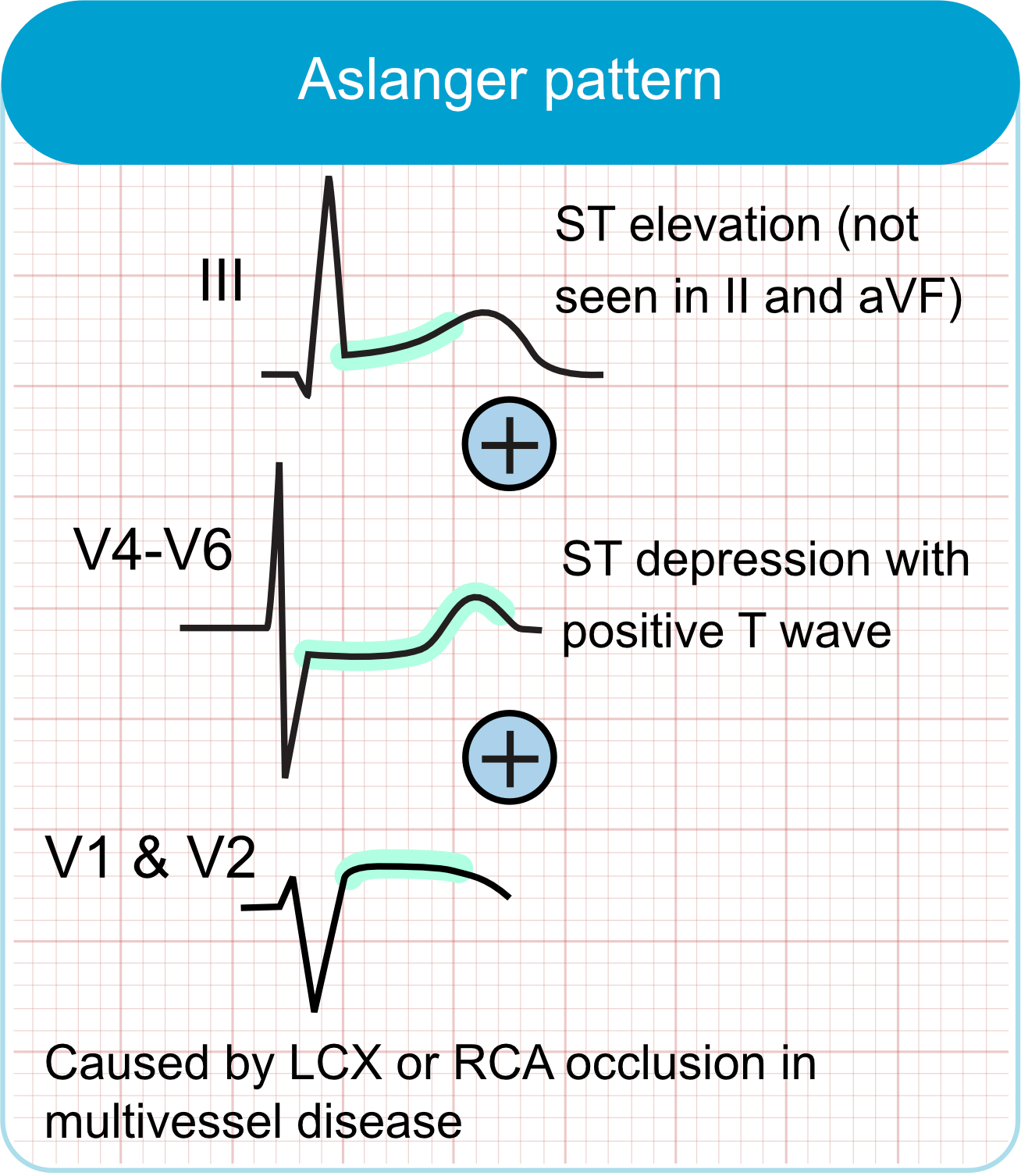 A New Approach to Acute Coronary Syndromes: Occlusion MI (OMI) vs. non ...