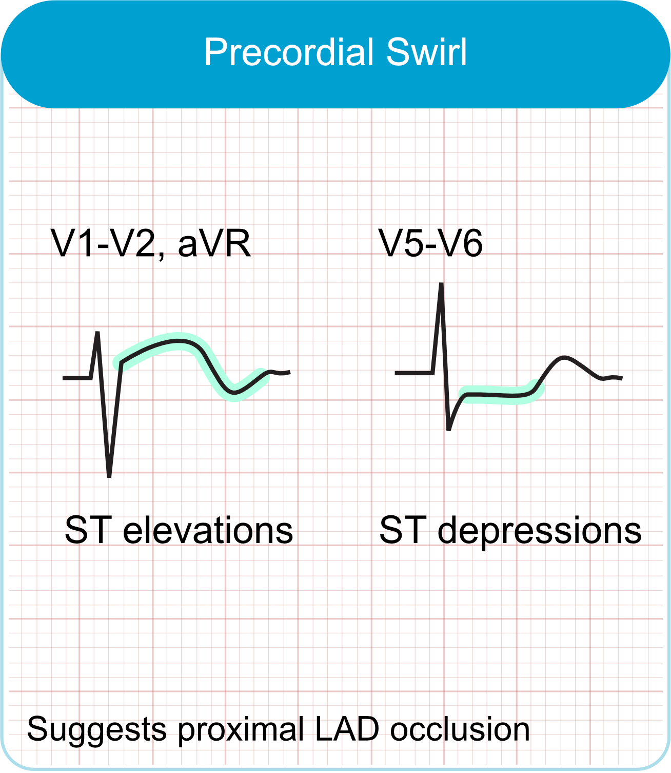 A New Approach to Acute Coronary Syndromes: Occlusion MI (OMI) vs. non ...
