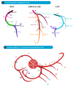 ECG manifestations of left main coronary artery (LMCA) occlusion and ...